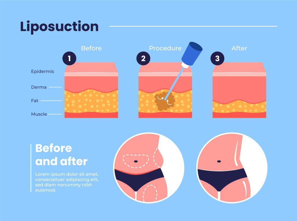 Lipedema – Causes and Solutions - Lipedema