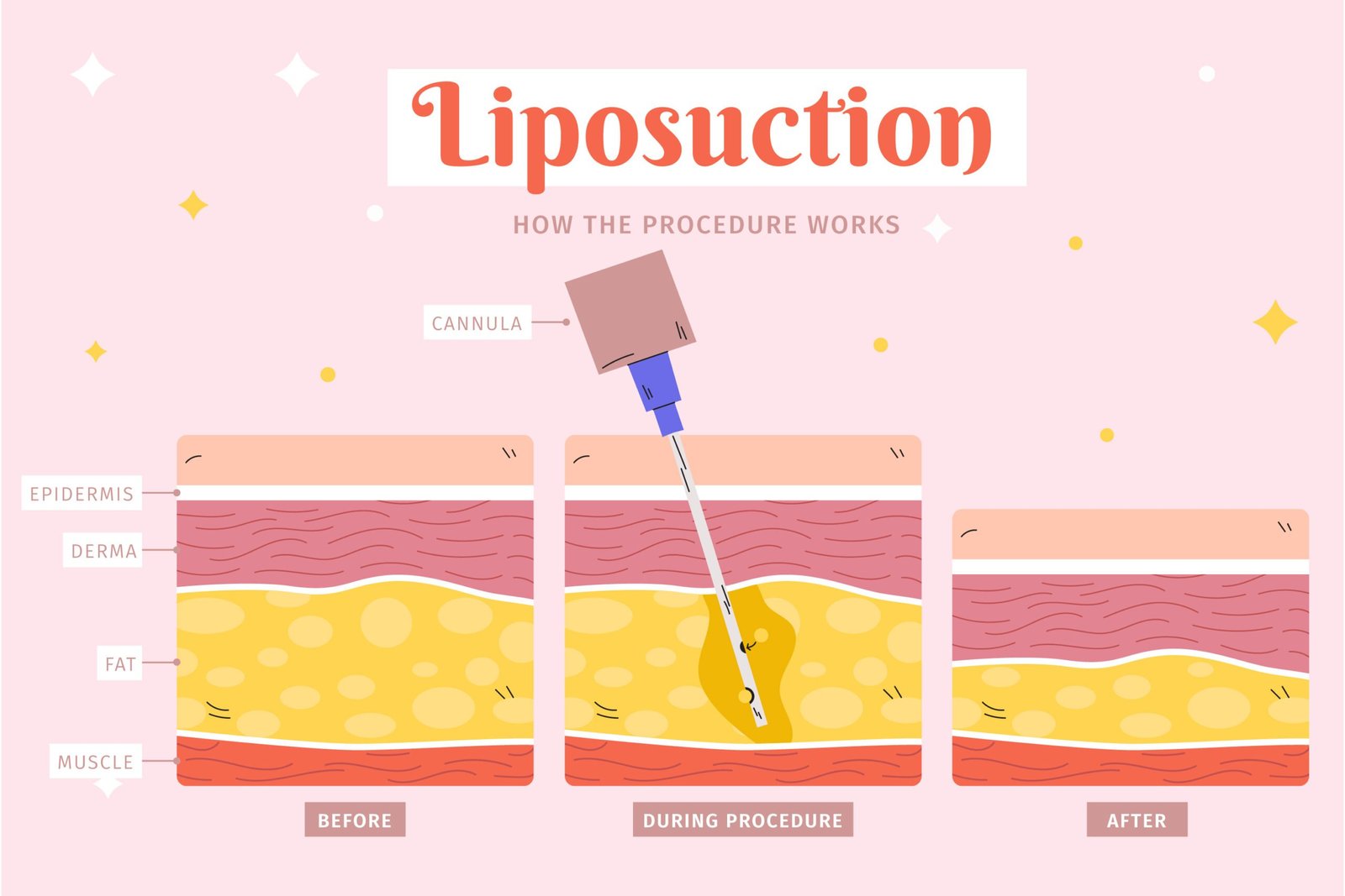 Lipedema progression after liposuction